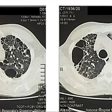 High Resolution Computed Tomography Of The Thorax Lung Window Axial