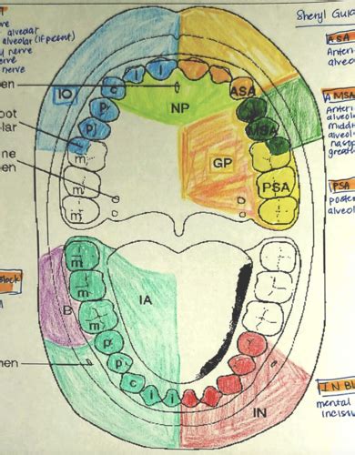 Maxillary Injections GP NP IO Flashcards Quizlet