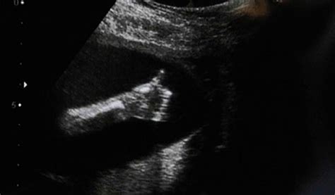 Bebê Faz Sinal De Que Está Tudo Bem Em Pleno Exame De Ultrassom