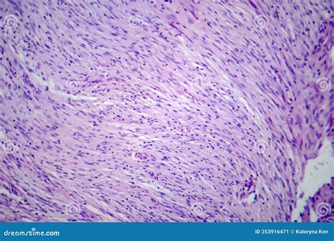 Meningioma Light Micrograph Photo Under Microscope Royalty Free Stock