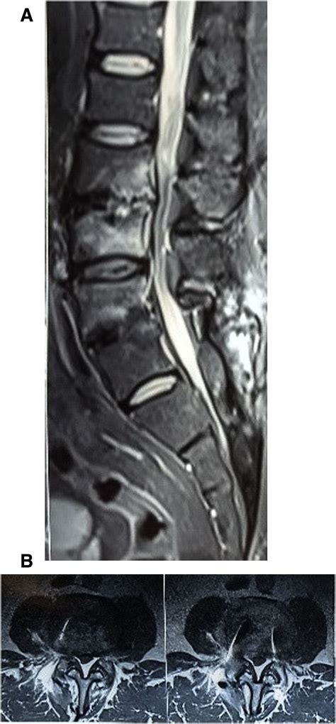 Espondilodiscitis Y Absceso Epidural Por Chryseobacterium Indologenes