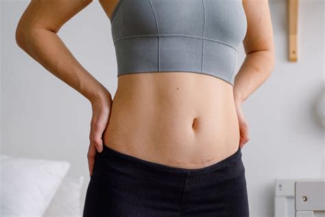 Permanent Numbness After C Section What Should You Do