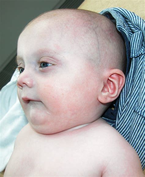 Congenital Ectodermal Dysplasia
