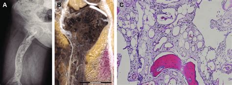 Angiomatosis Of Bone Gorham Stout Disease Vanishing Bone Disease Download Scientific