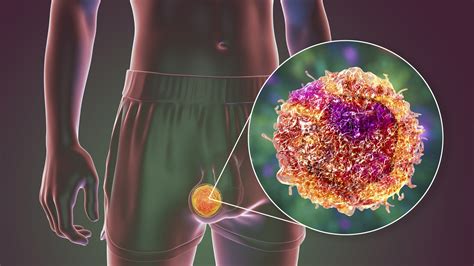 Testicular Cancer Colin Teo Urology