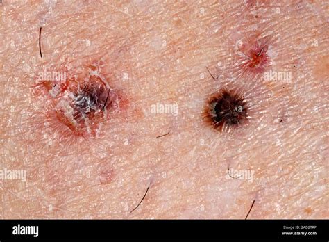 Skin Cancer And Non Cancerous Lesion Close Up Of A Malignant