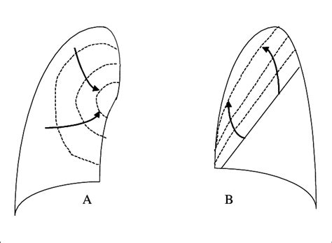 Combined Ru And Rml Atelectasis In Proí® í° Gress A On The Pa View