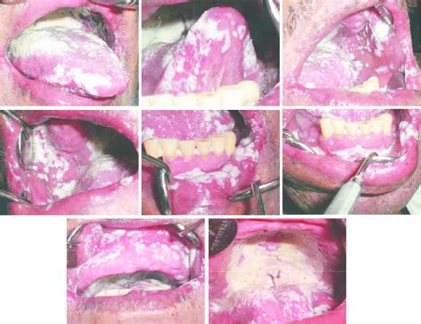 Visit I White Pseudomembrane On Almost All Over Oral Mucosa