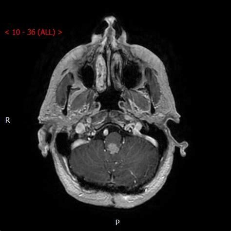 Posterior Fossa Ependymoma Image