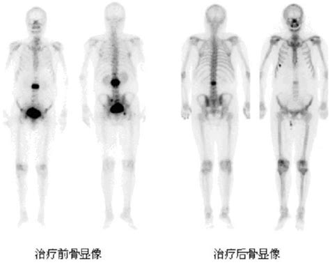 癌症骨轉移治療策略和飲食護理 每日頭條