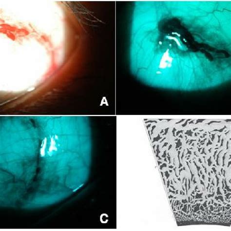 Well Visible Dilated Conjunctival Lymphatics White Arrow And