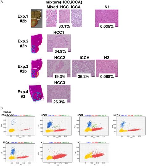 Figure 2 From Brief Communication Complex Phenotypic Heterogeneity Of Combined Hepatocellular
