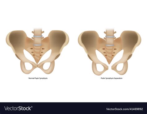 Pubic Symphysis Separation Or Spd Symphysis Pubis Vector Image