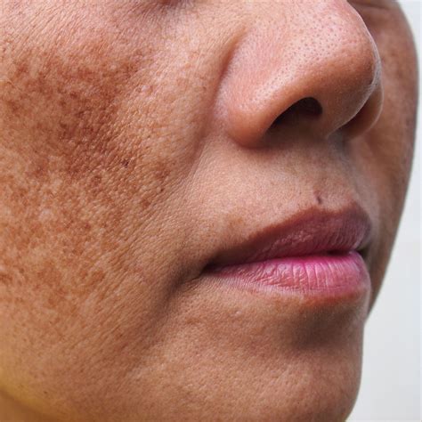 The 3 Main Types Of Melasma You Should Avoid