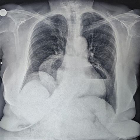 Morgagni Hernia View Of Thorax Ct Download Scientific Diagram