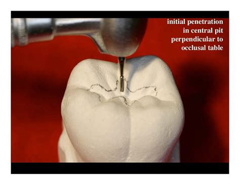 Class I Amalgam Cavity Design