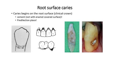 Dental Cavity Classification Systems Pptx