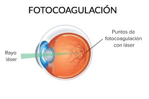 Especialistas en Fotocoagulación Oftalmólogos en México Grupo Visioni