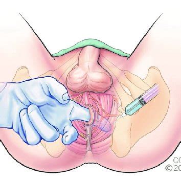 Transperineal Injection Of Pelvic Floor Muscles With Transrectal Download Scientific Diagram