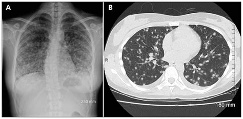 Histoplasmosis Lung