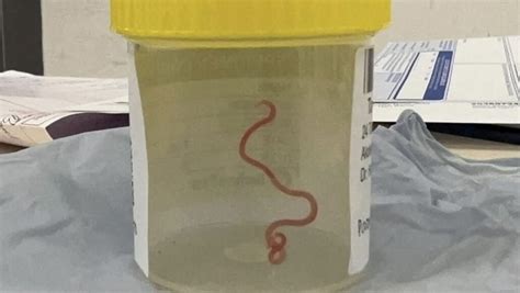 Doctors Found A Live Python Parasite In A Womans Brain
