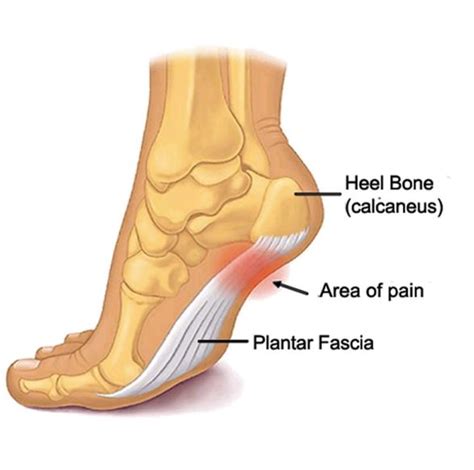 Management And Treatment Of Plantar Fasciitis With Mr Bal Dhinsa One