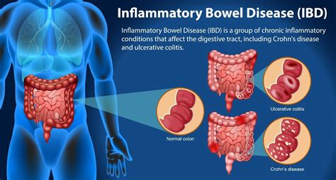 Western Diet Fuels Ibd By Derailing The Microbiome Can Precision