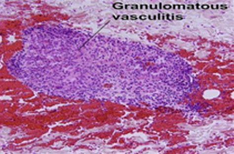 Granulomatus Vasculitis