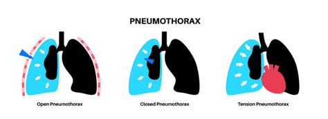 Pneumothorax Hemothorax And Hemopneumothorax Vector Image