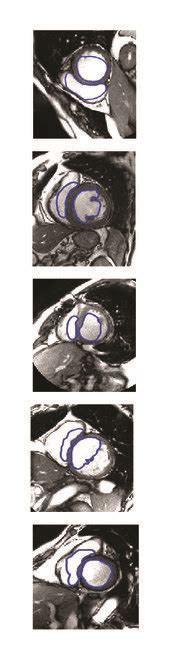 Segmentation Of Left And Right Ventricles A Original Images From
