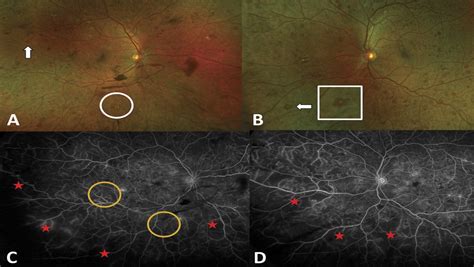 Atypical Proliferative Retinopathy As The Presenting Feature Retinal Cases And Brief Reports