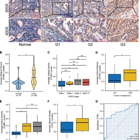 Expression And Clinical Correlation Analysis Of Knl1 In Ucec Clinical