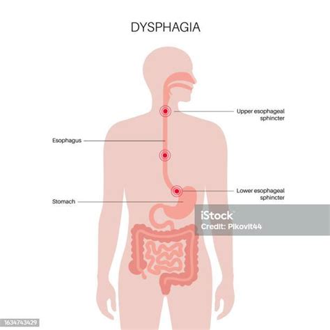 연하 곤란 의료 포스터 감기와 독감에 대한 스톡 벡터 아트 및 기타 이미지 감기와 독감 건강 진단 건강관리와 의술