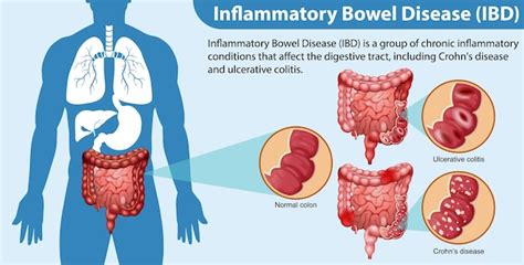 Free Vector Inflammatory Bowel Disease Ibd Infographic