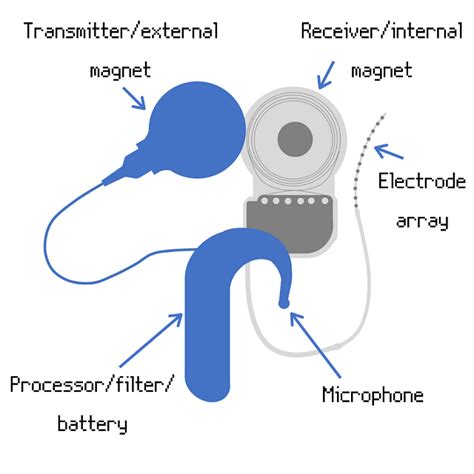 Cochlear Implants Who Needs One Everyday Hearing