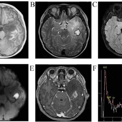 Case 1 Axial Brain Mri Displaying A Lesion In The Left Temporal Lobe