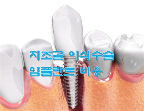 치조골 이식수술 임플란트 비용 총정리