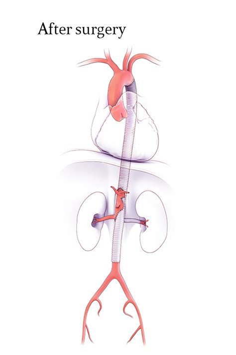 Aortic Dissection Surgery At Emory Heart And Vascular