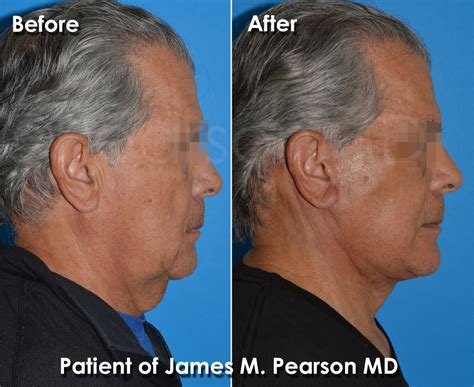 Before And After Photos Photo Gallery Dr James Pearson Facial Plastic