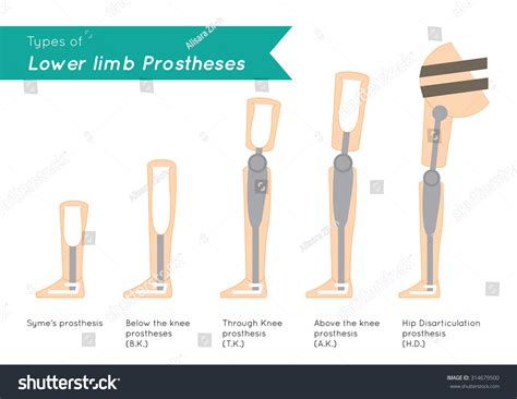 Stock Vektor Types Lower Limb Prosthetics Infographic Vector Bez