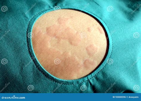 Éruption Cutanée Urticaria Réaction Allergique De Peau Photo stock Image du soin ceinture