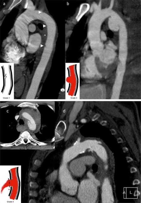 Traumatic Aortic Transection Wikem