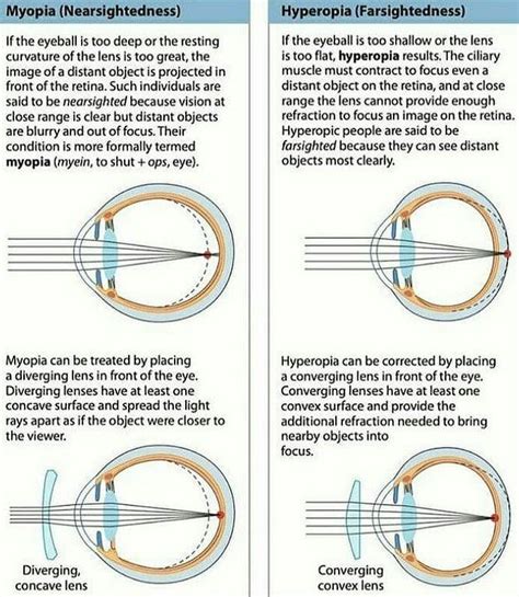 Myopia Vs Hyperopia Medical Physioworldwides Facebook