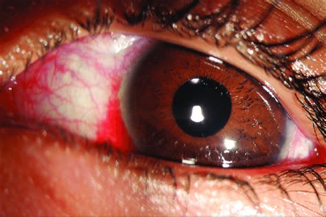 Eye With Idiopathic Ectopia Lentis First Day After Scleral Fixated