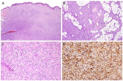 Rare Variants Of Dermatofibrosarcoma Protuberans Clinical Histologic
