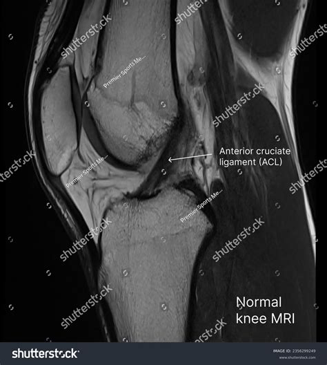 Anterior Cruciate Ligament Mri