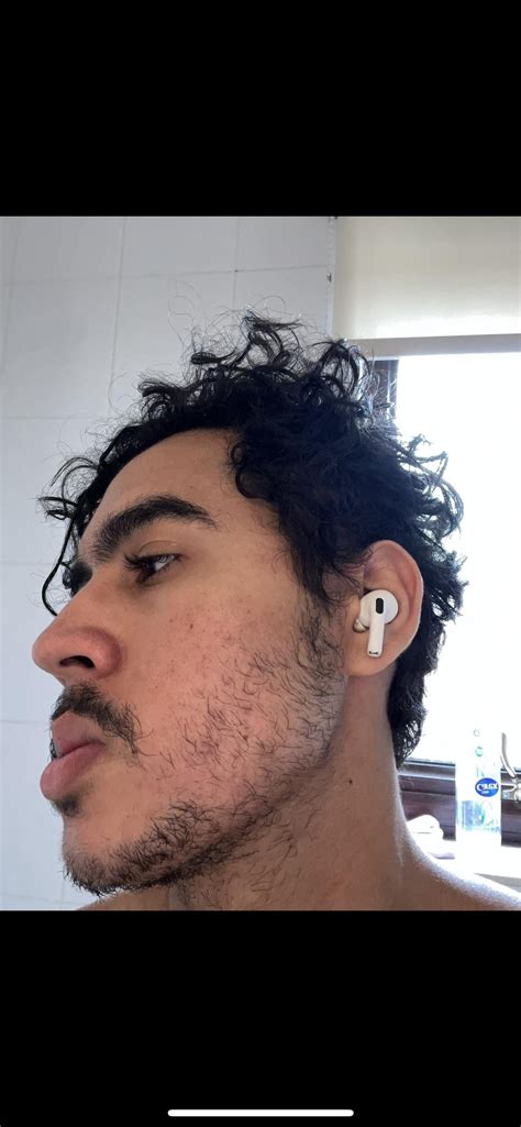 Approaching 7 Months On Minox Before After Rminoxbeards