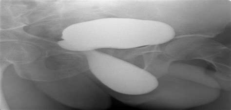 Retrograde Cystogram Download Scientific Diagram