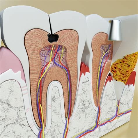 Teeth Pathologies Tooth 3d 3ds