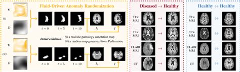 논문 리뷰 Unraveling Normal Anatomy via Fluid Driven Anomaly Randomization